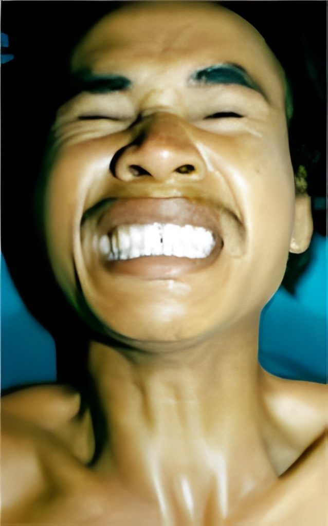 7 Shocking Effects of Risus Sardonicus - NIMHANS News Online