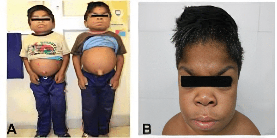 Understanding Hunter Syndrome: A Comprehensive Guide to a Rare Genetic ...